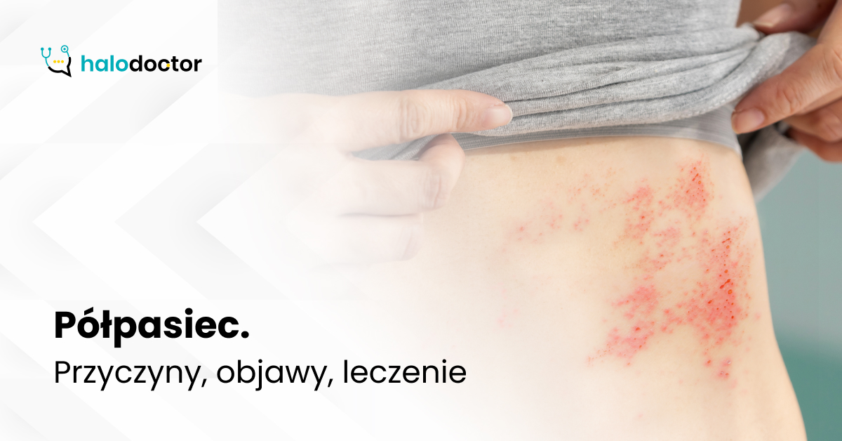 Półpasiec. Przyczyny, objawy, leczenie