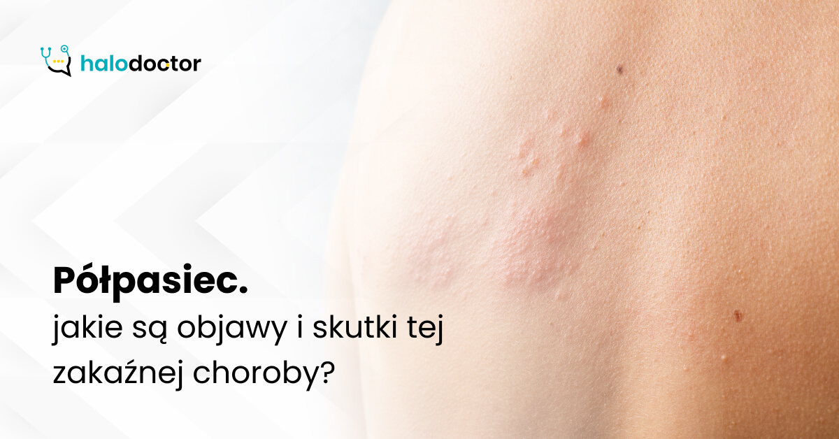 Półpasiec – objawy, przyczyny, leczenie