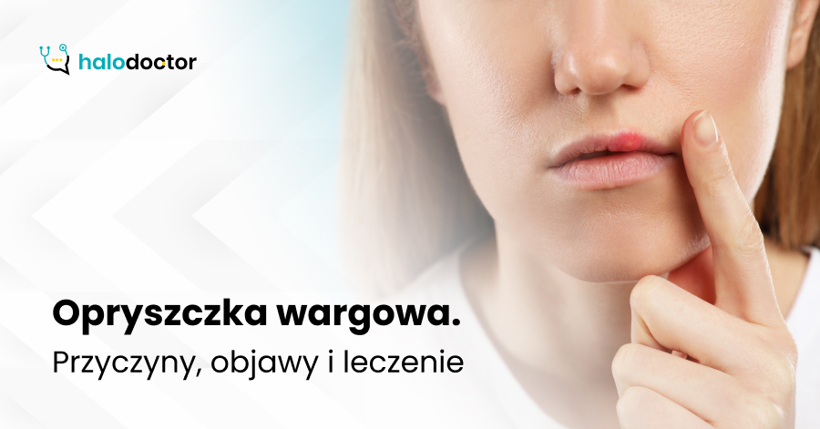 Opryszczka wargowa. Przyczyny, objawy i leczenie