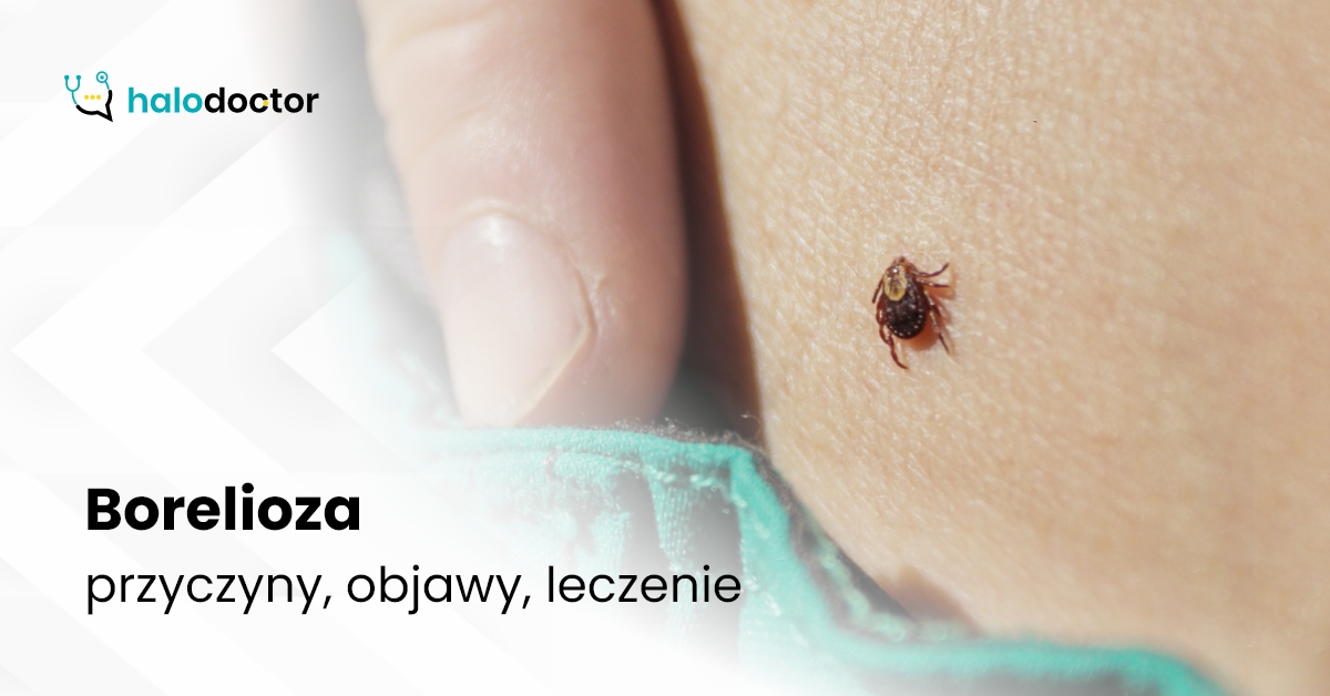 Borelioza - przyczyny, objawy, diagnostyka i leczenie
