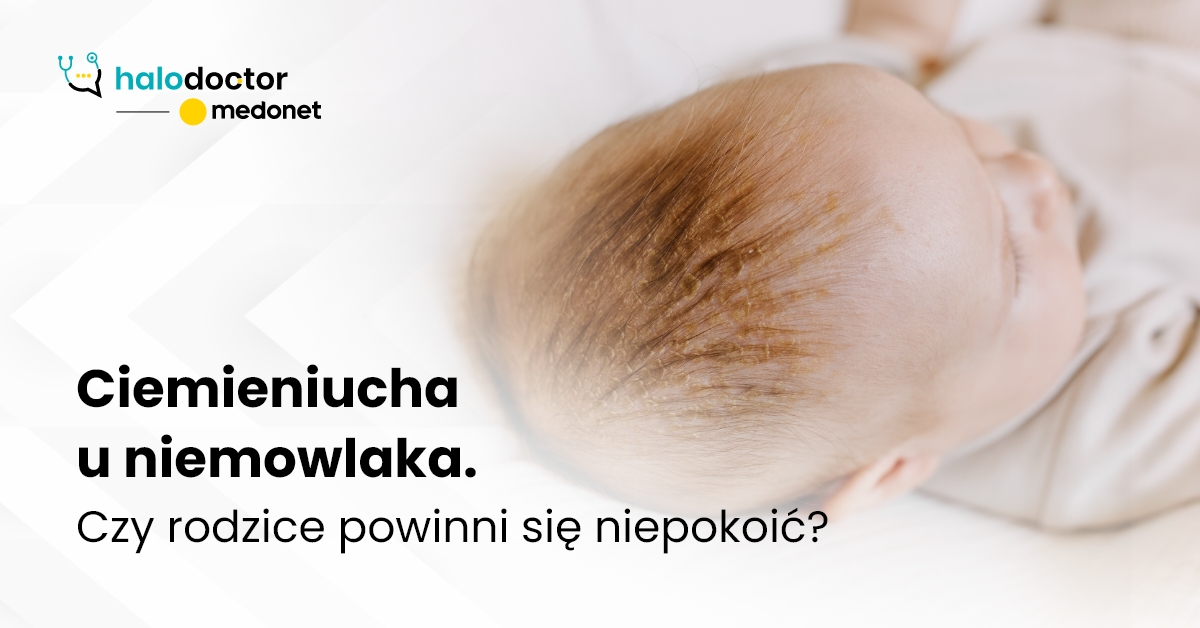Ciemieniucha u niemowlaka. Czy rodzice powinni się niepokoić